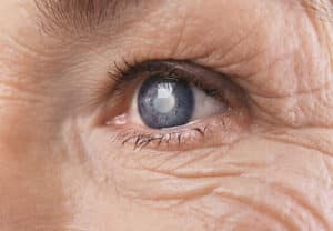 Cataracts Brownstown | Cataract Surgery Detroit | Rahmani Eye